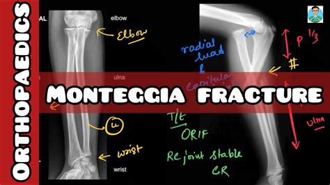 Monteggia Fracture Made Simple For Usmle Youtube