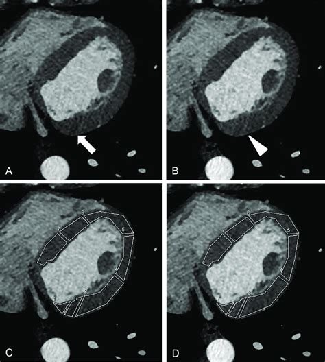 Beam Hardening Artifact And Roi Measurements Performed A Streak Like Download Scientific