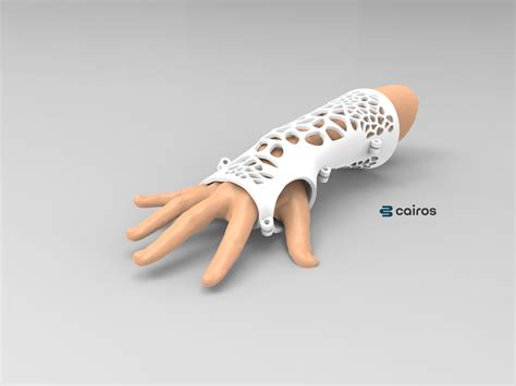 Stl File Arm Splint 💪・template To Download And 3d Print・cults Stl File Arm Splint 💪・template To Download And 3d Print・cults