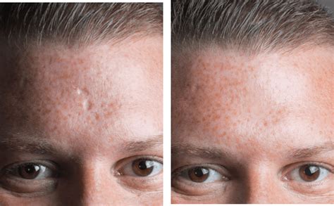 How To Get Rid Of Acne Scars Dermaflage
