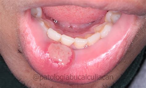 Estomatitis Patología Y Medicina Bucal Julio Basurto