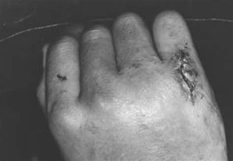 Bite Marks On Human Flesh