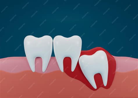 Premium Photo 3d Render Of Teeth With Wisdom Mesial Impaction