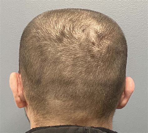 Male Temporal Reduction Back 2 Dr Barry Eppley Explore Plastic Surgery