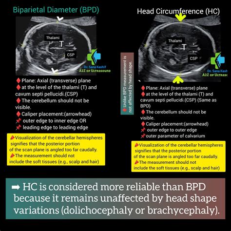 Ultrasound Techs Resource 💢 Bpd Biparietal Diameter And Hc Head