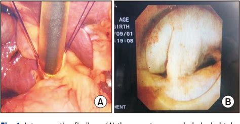 Figure 1 From Outcomes Of Laparoscopic Choledochotomy Using