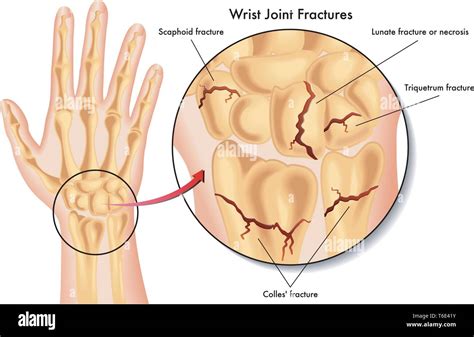 Scaphoid Fossa Wrist