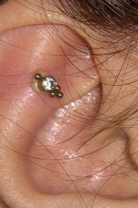 Product Question Do Microdart Pimple Patches Cause Scarring R