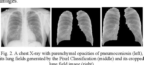 Figure 4 From Automated Pneumoconiosis Detection On Chest X Rays Using Cascaded Learning With