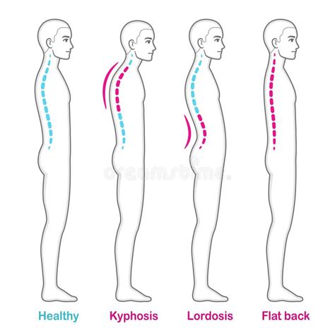 Posture And Back Problems Spine Infographic Stock Vector Illustration
