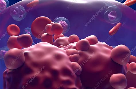 Acute Lymphoblastic Leukemia Illustration Stock Image F038 5779 Science Photo Library