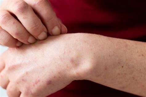 இலங்கையில் அதிவேகமாக பரவும் டினியா நோய் பொதுமக்களுக்கு சுகாதார எச்சரிக்கை