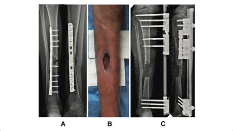 A 42 Year Old Man Who Suffered Chronic Osteomyelitis In His Right