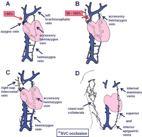 Superior Vena Cava Syndrome Anatomy