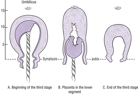 Principles Of Intrapartum Skills Third Stage Issues Nurse Key