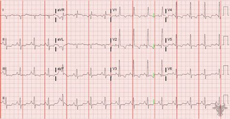 Right Heart Strain Ecg Stampede