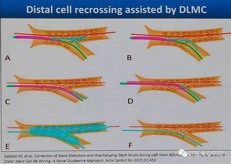冠脉分叉病变治疗策略详解！ 好医术文章 好医术 赋能医生守护生命