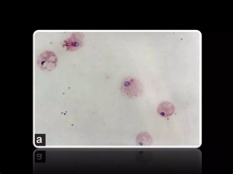Role Of Cytology In Renal Lesions Pptx