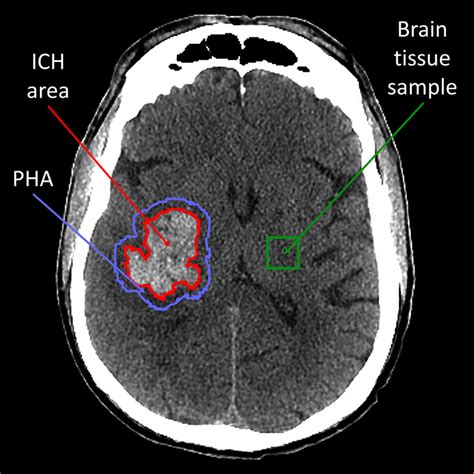 exemplary axial head ct image segmentation red contour intracerebral