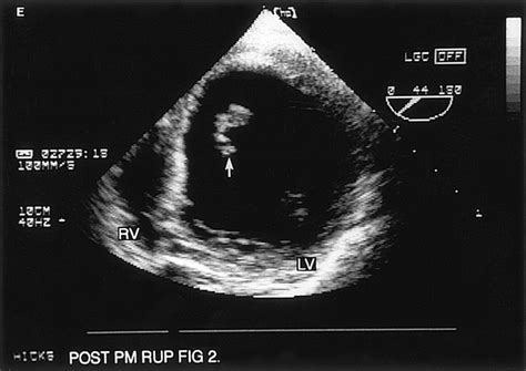 Transesophageal Echocardiographic Assessment Of Papillary Muscle
