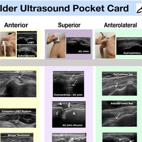 Pocus 101 On Instagram New Pocus 101 Blog Post On Shoulder Ultrasound With A Free Downloadable