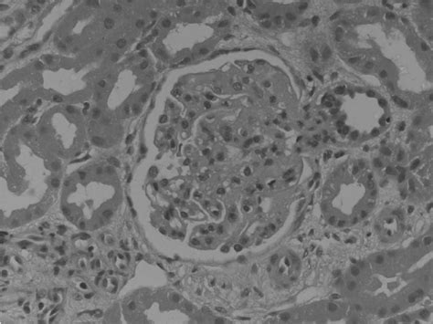 Early Mesangial Sclerosis Haematoxylin Eosin 600 Download Scientific Diagram