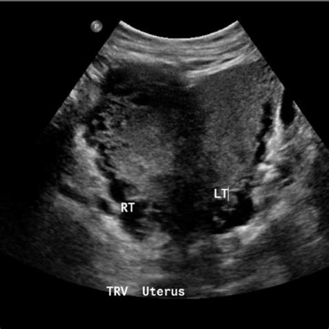 Bicornuate Uterus Ultrasound Spontaneous Twin Pregnancy In Uterus