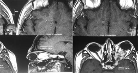 Mri Showing An Antero Posteriorly Oblong Fusiform Lesion Measuring