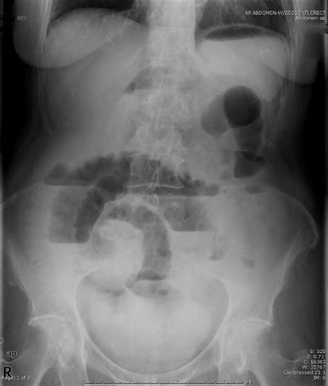Imagesmall Bowel Obstruction Upright Radiograph Merck Manual
