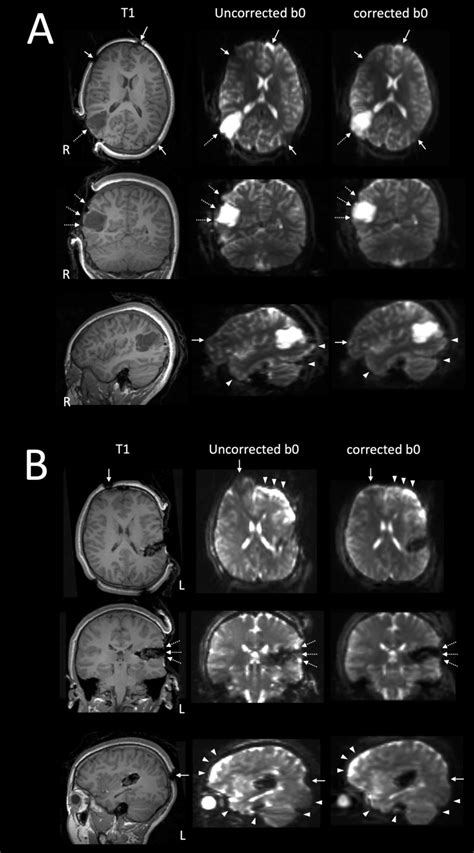 two case examples illustrating the quality of dwi epi distortion