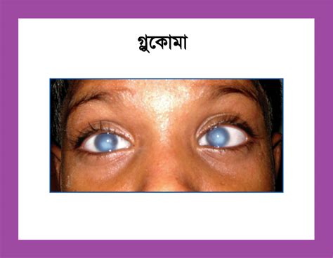 Glaucoma Eye Care Information Bangladesh