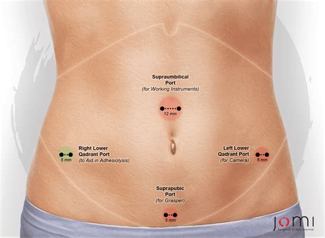 Laparoscopic Appendectomy With Lysis Of Adhesions For Appendicitis
