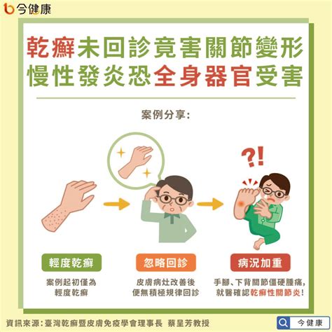 常常關節痛、下背痛？當心是乾癬在作怪！認識「乾癬性關節炎」 健康 Nownews今日新聞