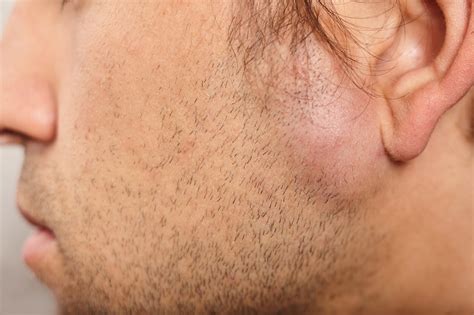 Absces Komplexní Přehled Pilulka Cz