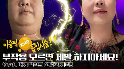 이중턱 지방흡입시술 부작용 모르면 절대 하지마세요 Feat 내가 이 병원을 선택 한 이유 Youtube