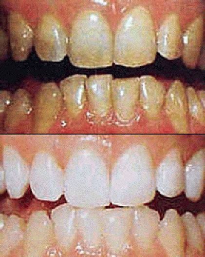 The Effects Of Accutane On Bleached Teeth Intelligent Dental