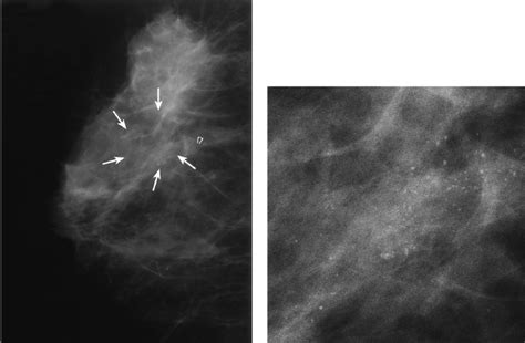 Calcifications Small Roundpunctate Radiology Key