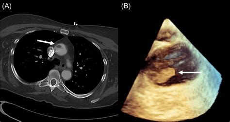 A Axial Computed Topography Angiography Showing A Filling Defect In