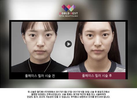 인생 필러