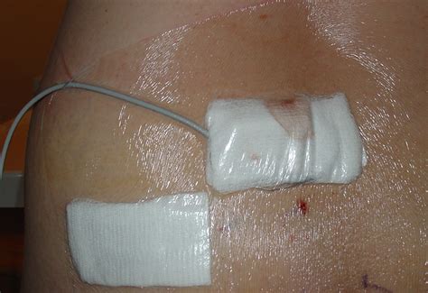 Day 1 After Part 1 Surgery Of Interstim Random Thoughts