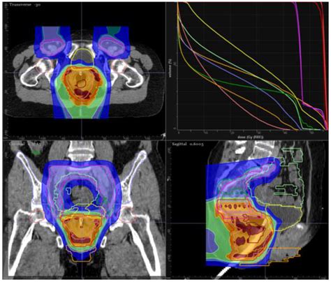 Example Of Pencil Beam Scanning Proton Plan For Patient With Early