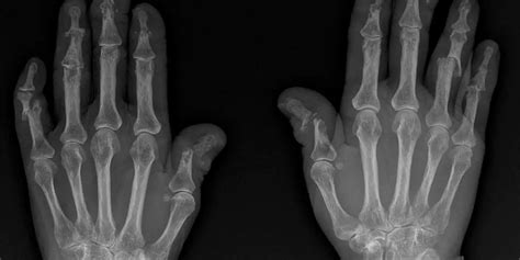 Psoriatic Arthritis X Ray What To Expect