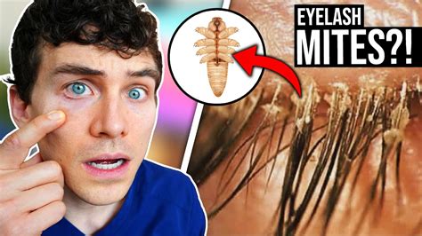 Eyelash Mite Photos A Visual Guide To Identifying Demodex