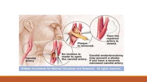 External Carotid Artery Ligation Of External Carotid Artery Lingual