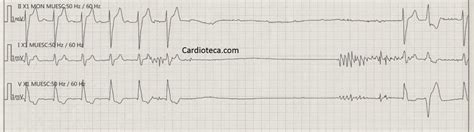 Tira De Ecg De Actividad Eléctrica Sin Pulso