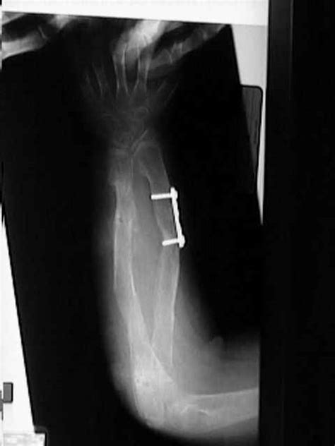 Multiple Cartilaginous Exostoses Hereditary Exostosis Wheeless Textbook Of Orthopaedics