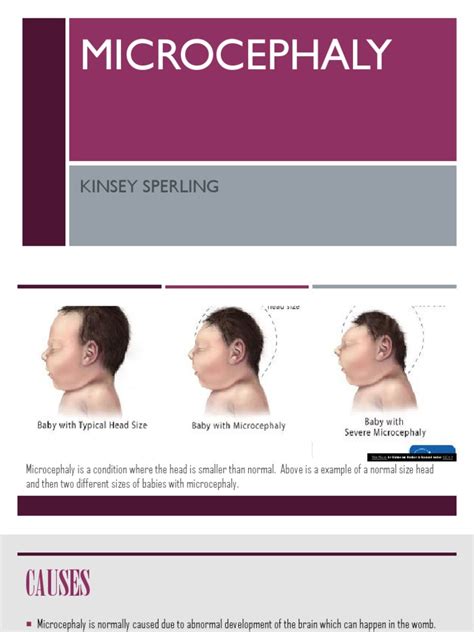 Microcephaly Pdf Prenatal Development Medicine