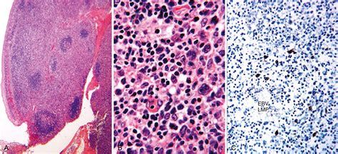 Immunohistology Of Lymph Node And Lymph Node Neoplasms Clinical Tree
