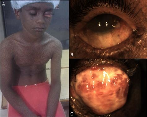Xeroderma Pigmentosum With Bilateral Ocular Surface Squamous Neoplasia And Review Of The Xeroderma Pigmentosum With Bilateral Ocular Surface Squamous Neoplasia And Review Of The
