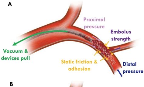 Sofia Catheter For Direct Aspiration Of Large Vessel Occlusion Stroke A Single‑center Cohort